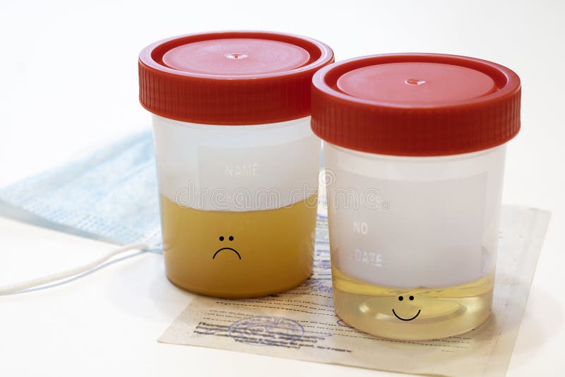 Urine Container and Direction, Good and Bad Urinalysis. Disposable ...