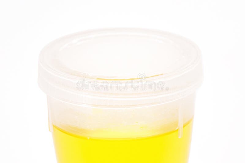 Urine for Examination Collected in Disposable Plastic Bottle ...