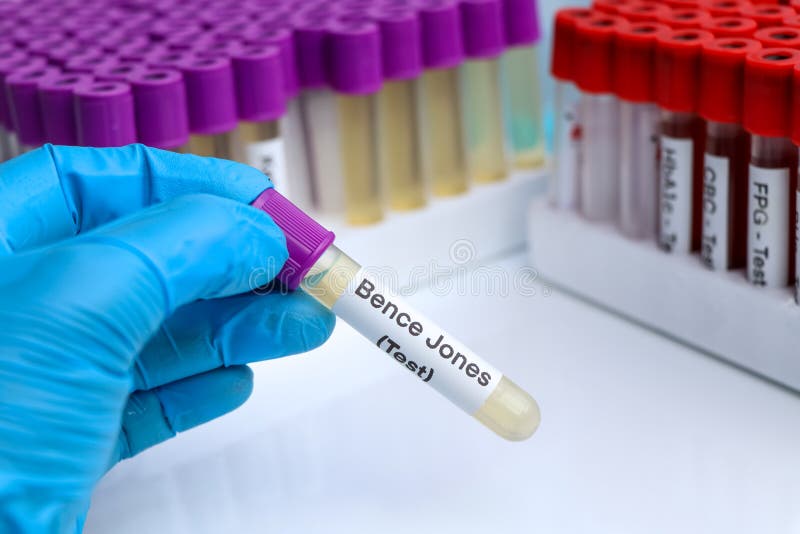 Urine Samples for Testing Bence Jones in the Laboratory Stock Image ...