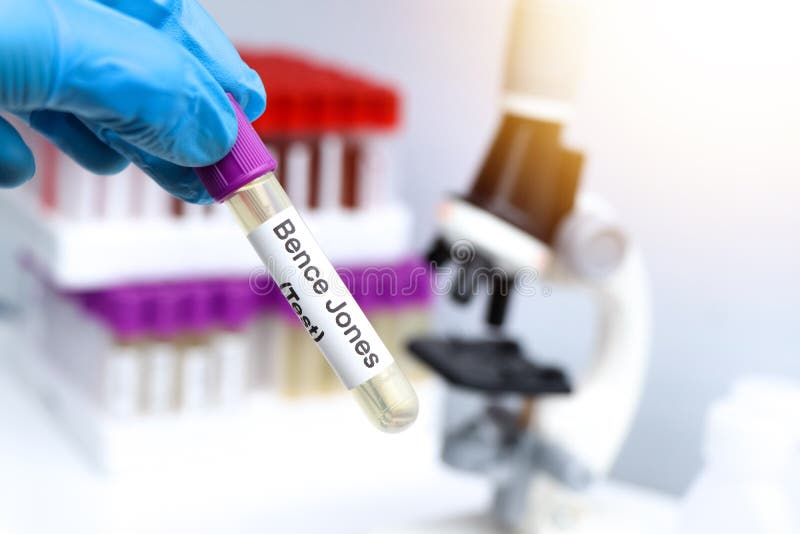 Urine Samples for Testing Bence Jones in the Laboratory Stock Photo ...