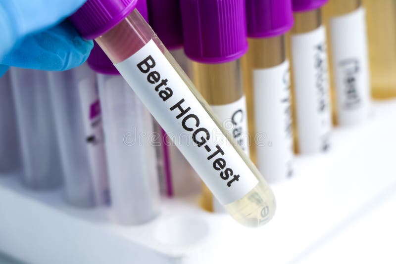 Urine Samples for Testing HCG in the Laboratory Stock Image - Image of ...