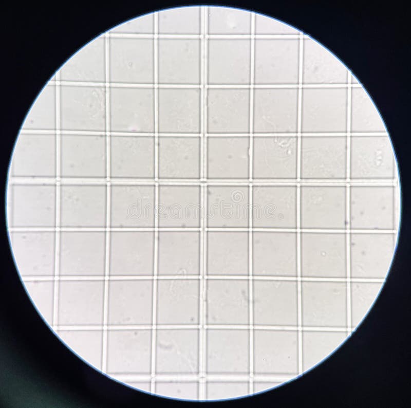 Urine Sediment with Scale Finding with Microscope Stock Photo - Image ...
