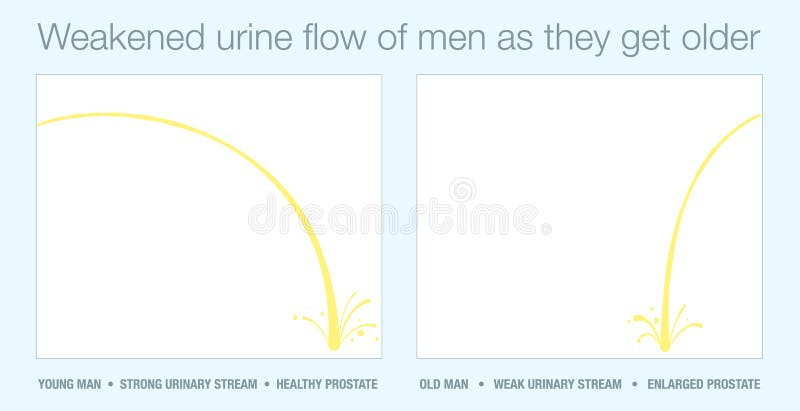Urine Stream Enlarged Prostate Weak Strong Urinary Flow Young Old Man ...