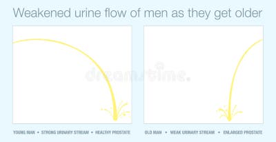 Urine Stream Enlarged Prostate Weak Strong Urinary Flow Young Old Man ...