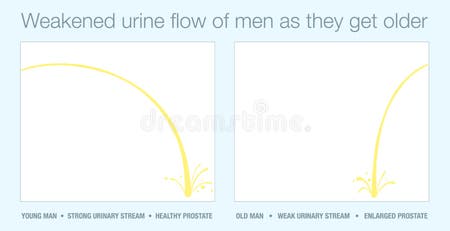 Urine Stream Enlarged Prostate Weak Strong Urinary Flow Young Old Man ...