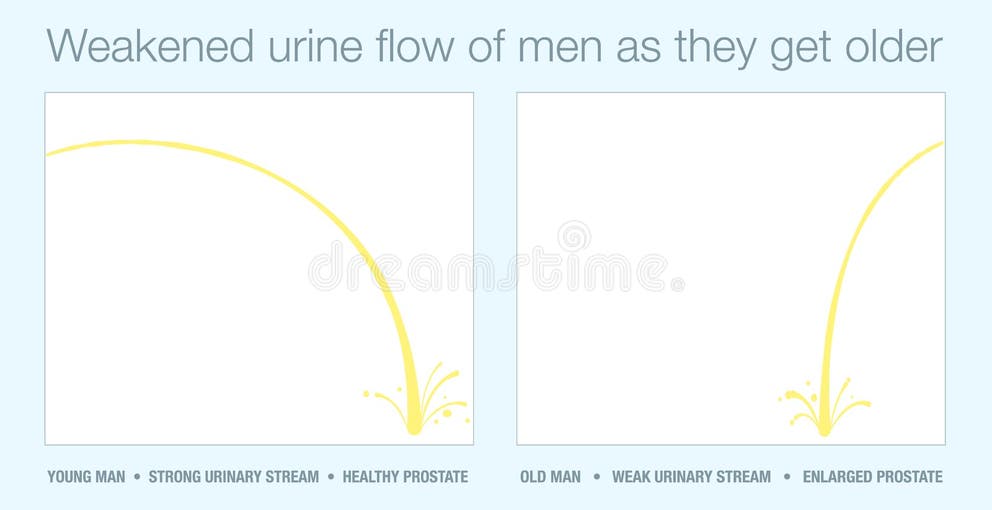 Urine Stream Enlarged Prostate Weak Strong Urinary Flow Young Old Man ...
