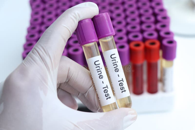 Urine Test To Look for Abnormalities from Urine, Urine Sample To ...