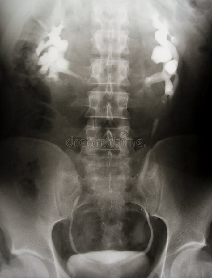 Urographie Intraveineuse, Examen Radiologique Image stock - Image du ...