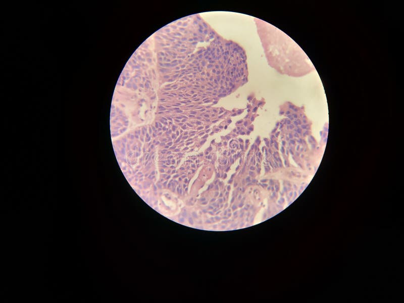 Urothelial Transitional Cell Carcinoma Stock Image - Image of carcinoma ...