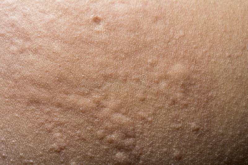 Urticaria or allergy rash stock photo. Image of closeup - 80618598