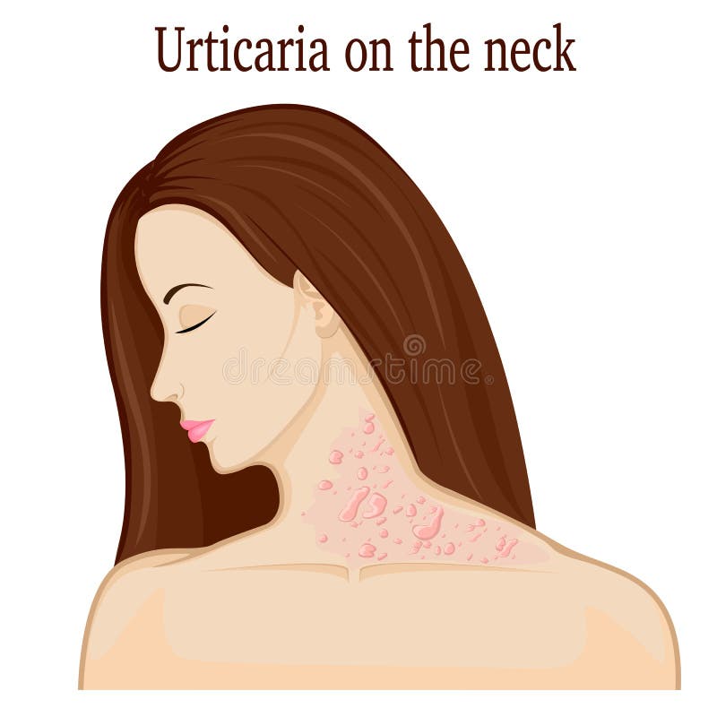 Urticaria op de hals vector illustratie. Illustration of hoofd - 77916554