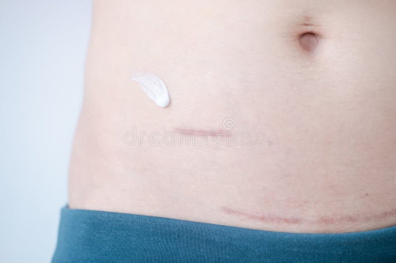 Appendix Scar Stock Photos - Free & Royalty-Free Stock Photos from ...