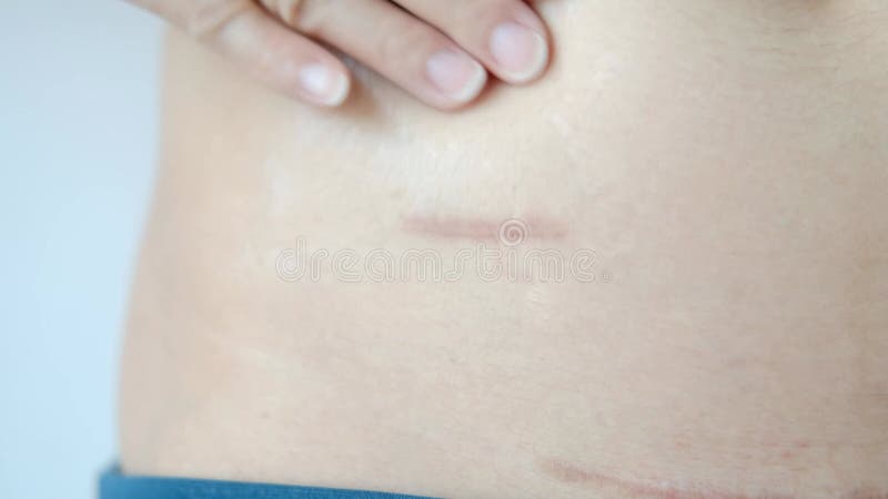 Using Cream To Care for Scars after Appendix Surgery. Stock Video ...