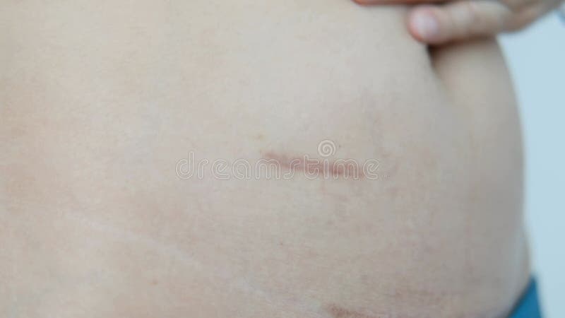 Using Cream To Care for Scars after Appendix Surgery Stock Video ...