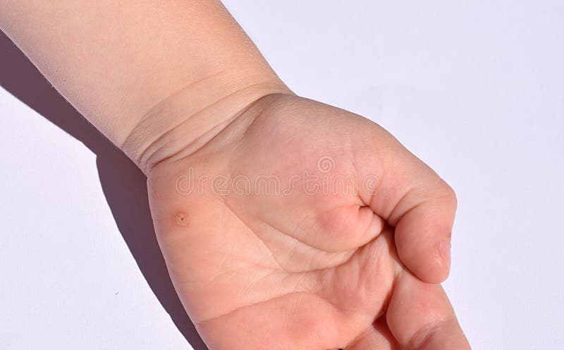 Verruca's Stock Photos - Free & Royalty-Free Stock Photos from Dreamstime