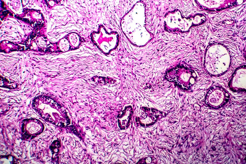 124 Neoplasm Uterus Stock Photos - Free & Royalty-Free Stock Photos ...