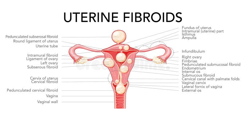Polyp In The Uterus With Inscriptions Diagram Female Reproductive