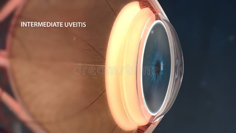 Uveitis is the Inflammation of Part or All of the Uvea in the Eye. it ...