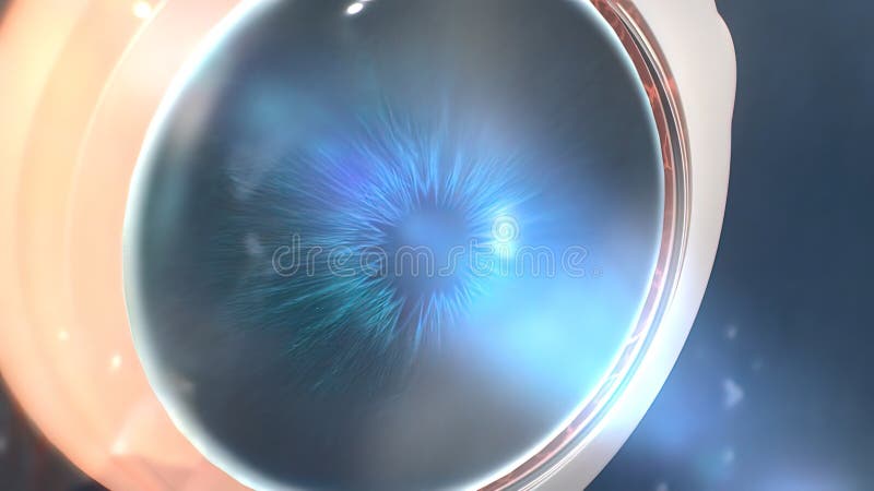 Uveitis is the Inflammation of Part or All of the Uvea in the Eye. it ...
