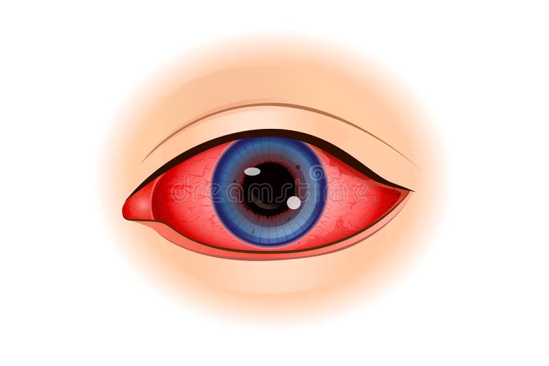 Eye Inflammation Stock Illustrations – 2,186 Eye Inflammation Stock ...