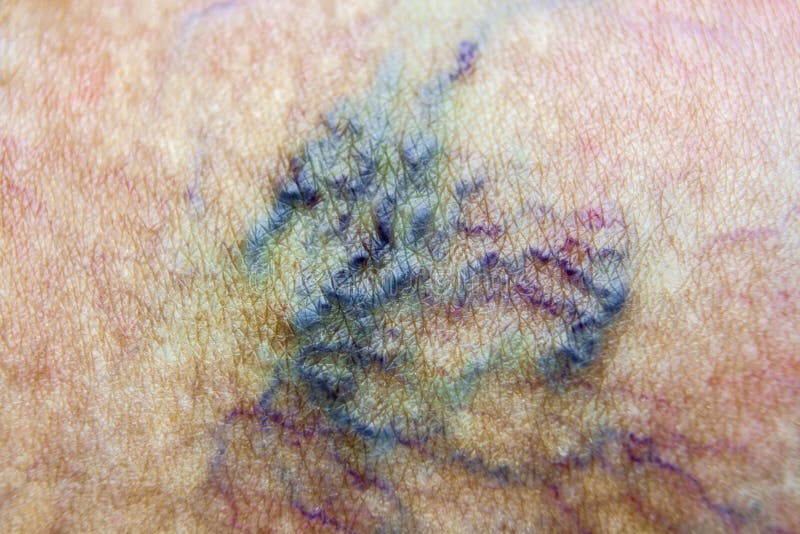 Vain variqueux image stock. Image du caucasien, médical - 41116715