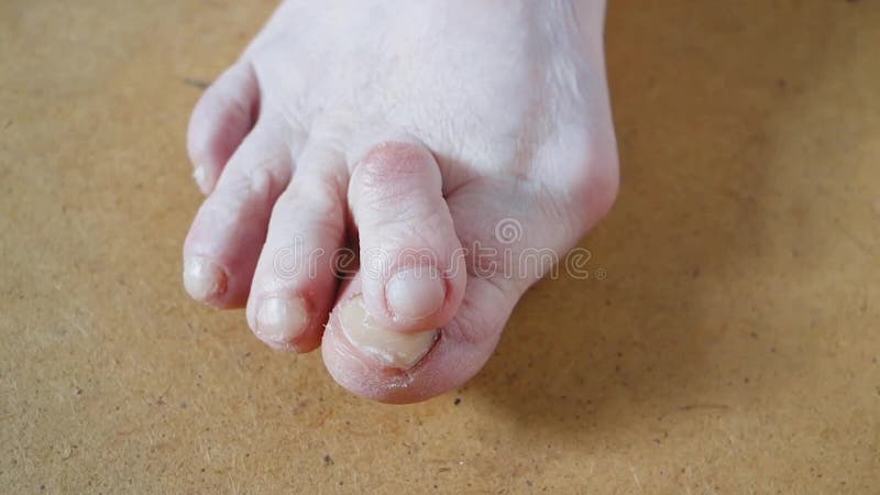 Deformation of the Joint on the Leg Abnormal Stock Footage - Video of ...