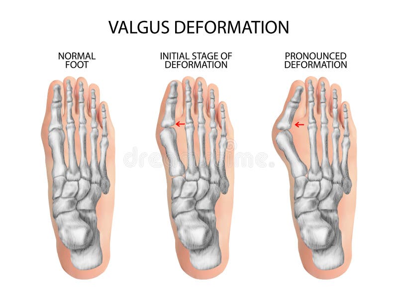 Valgus Deformity of the Toes. Stock Illustration - Illustration of ...