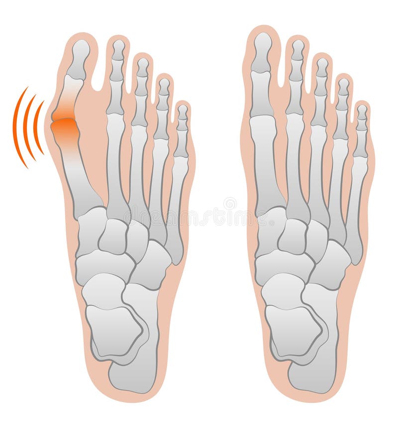 Age and Valgus Deformity of the Thumb. Bunion. Stages of Development of ...