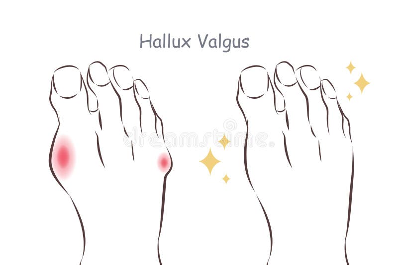 Valgus Normal Del Pie Y Del Hallux Ilustración del Vector - Ilustración ...