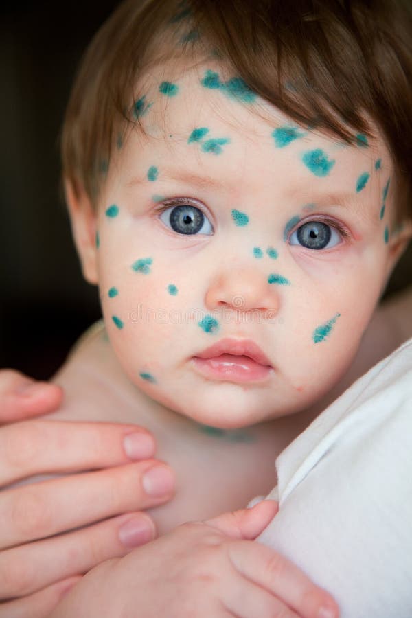 Varicelle chez les enfants photo stock. Image du pose - 27398468