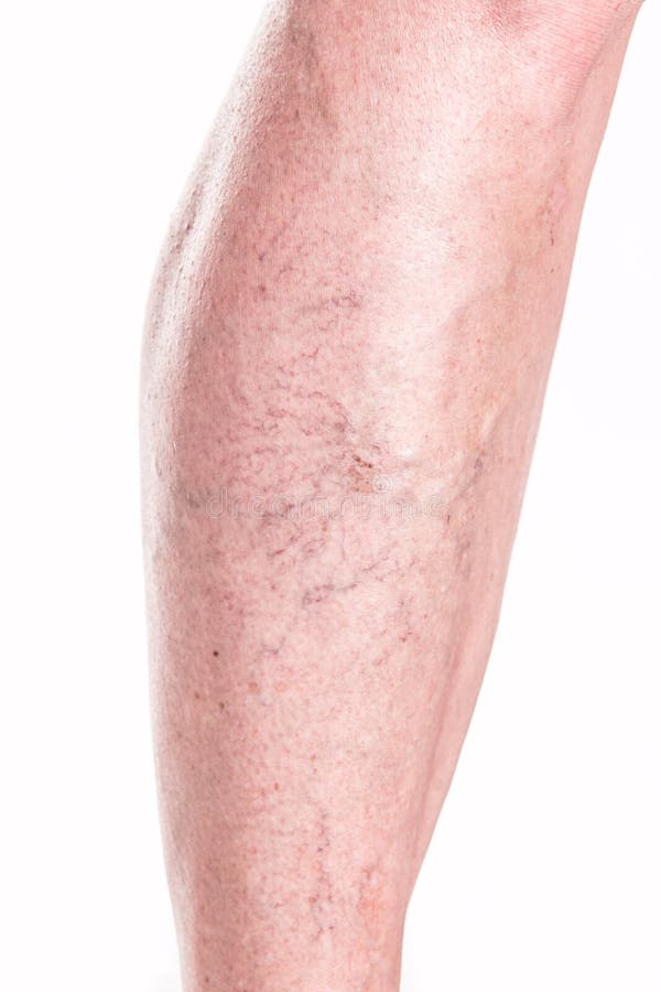 Varices En Las Piernas De La Mujer Imagen de archivo - Imagen de cambio ...