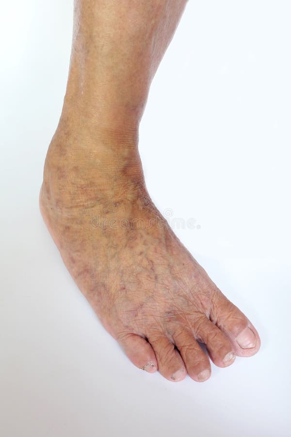 Varices En Los Pies Y Las Piernas Imagen de archivo - Imagen de collage ...