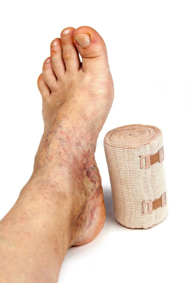 Varices En Los Pies Y Las Piernas Foto de archivo - Imagen de salud ...