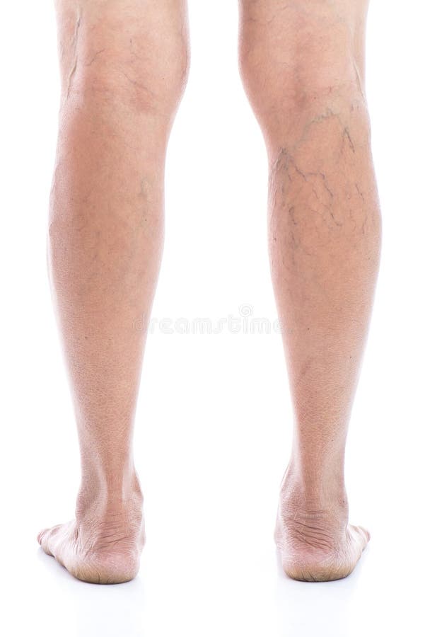 Varicose Vein Isolated on White Stock Photo - Image of vein, isolated ...