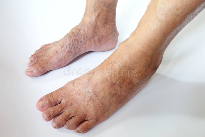 Varicose Veins in the Feet and Legs. Stock Photo - Image of female ...