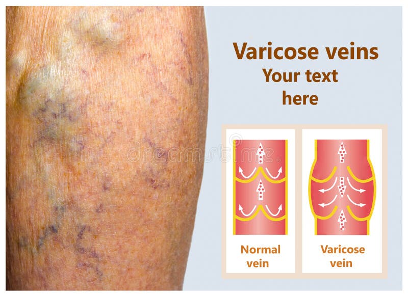 Varicose Veins on a Female Senior Leg Stock Photo - Image of copy ...