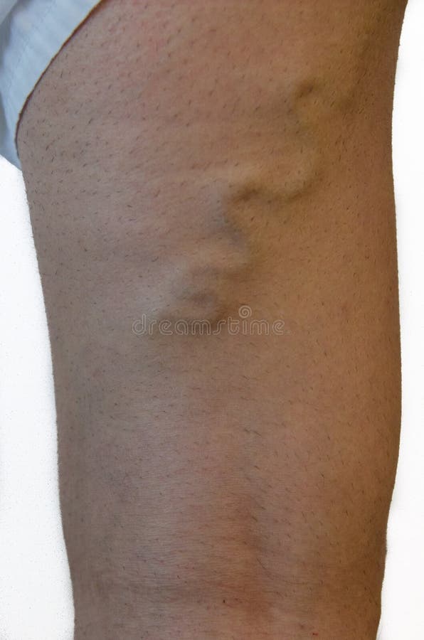 Varicose veins on a leg. stock image. Image of standing - 69945465