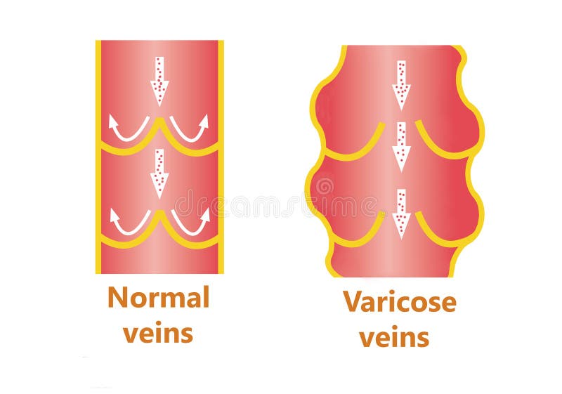 The Varicose Veins and Normal Veins Stock Illustration - Illustration ...