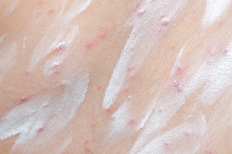 Variole image stock. Image du contagieux, patient, fièvre - 51782149