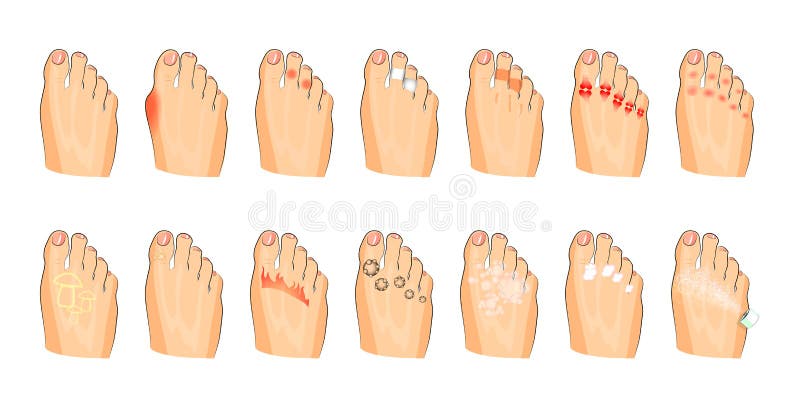 Various foot damage stock vector. Illustration of adhesive - 65196465