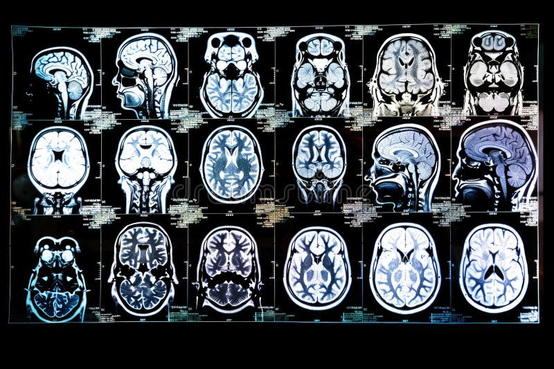 Various MRI Scans Showcasing Different Regions of the Brain Under a ...