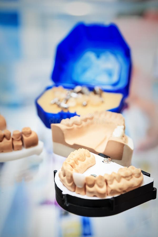 Casts of dentures. stock image. Image of ceramic, clinic - 128373243