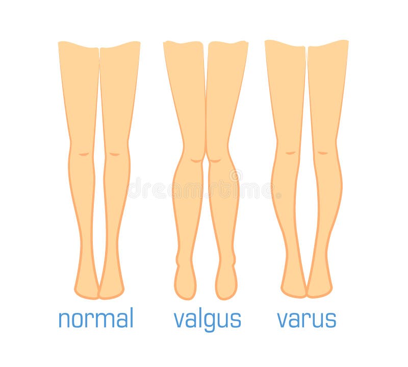 Diferencia De Tipos De ángulos De Piernas Y De Rodillas Ilustración ...