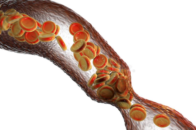 Vasoconstriction Globules Rouges Traversant Le Vaisseau Sanguin ...