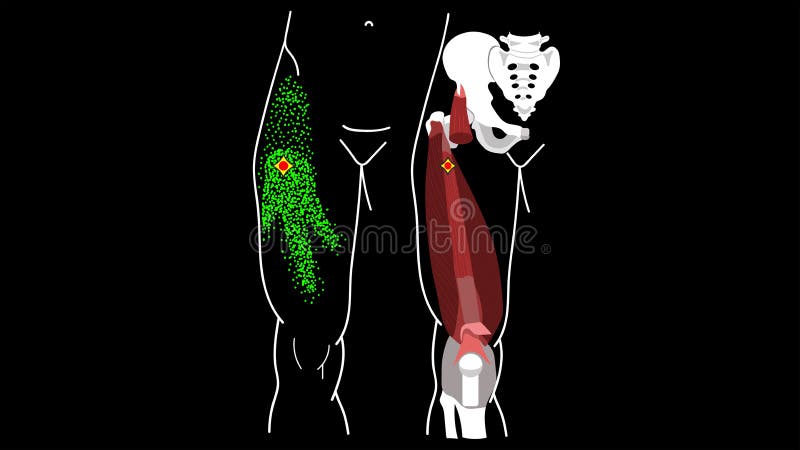 Trigger Point Therapy Stock Illustrations – 65 Trigger Point Therapy ...