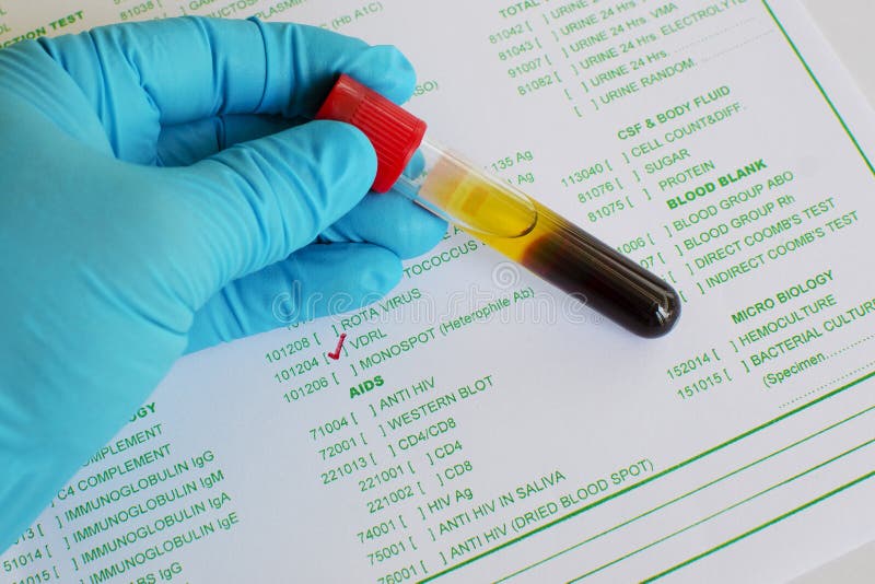 VDRL testing stock image. Image of sickness, test, science - 57916133