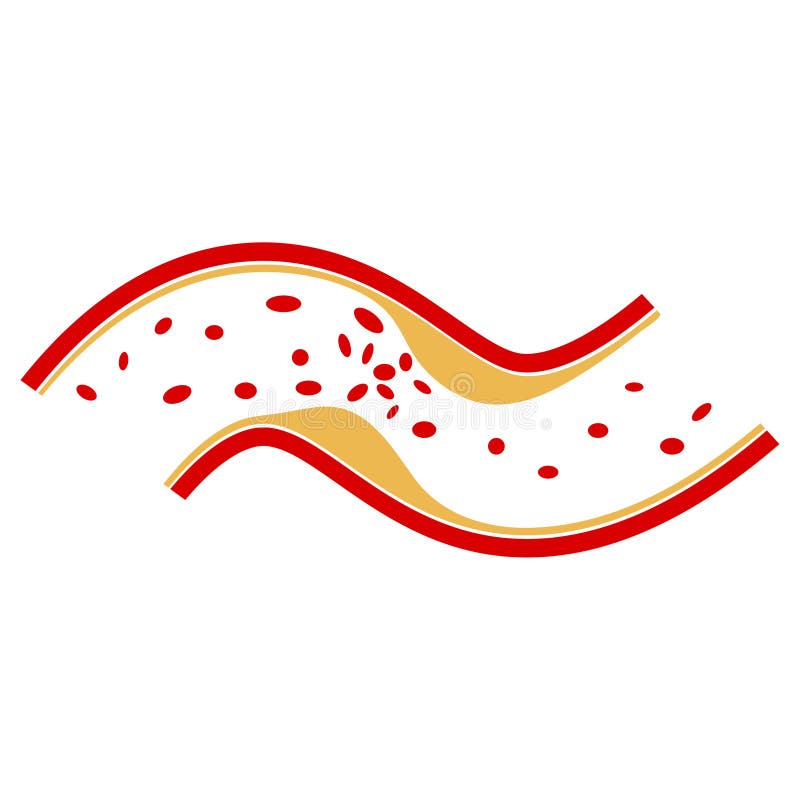 Vector of Cholesterol Plaque Stock Illustration - Illustration of ...