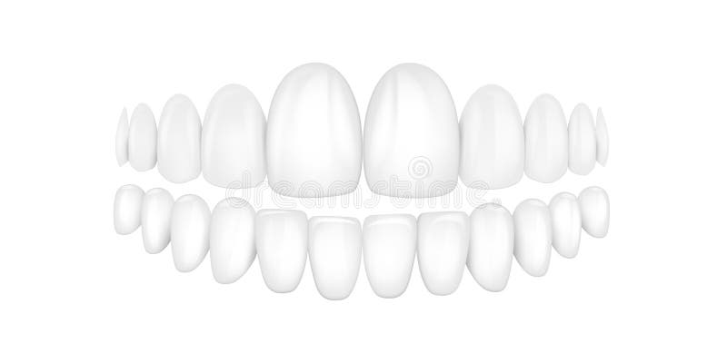 Human Teeth and Dental Implant Vector in Gum Mockup. Stock Vector ...