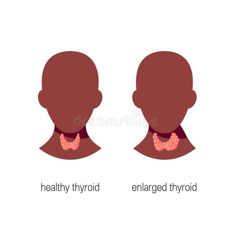 Vector De La Enfermedad Del Bocio Ilustración del Vector - Ilustración ...