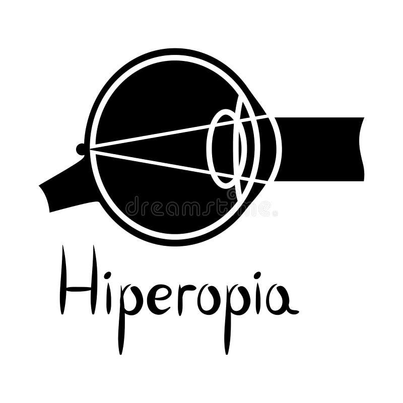 Vector Design of Hyperopia and Eyeball Logo. Web Element of Hyperopia ...